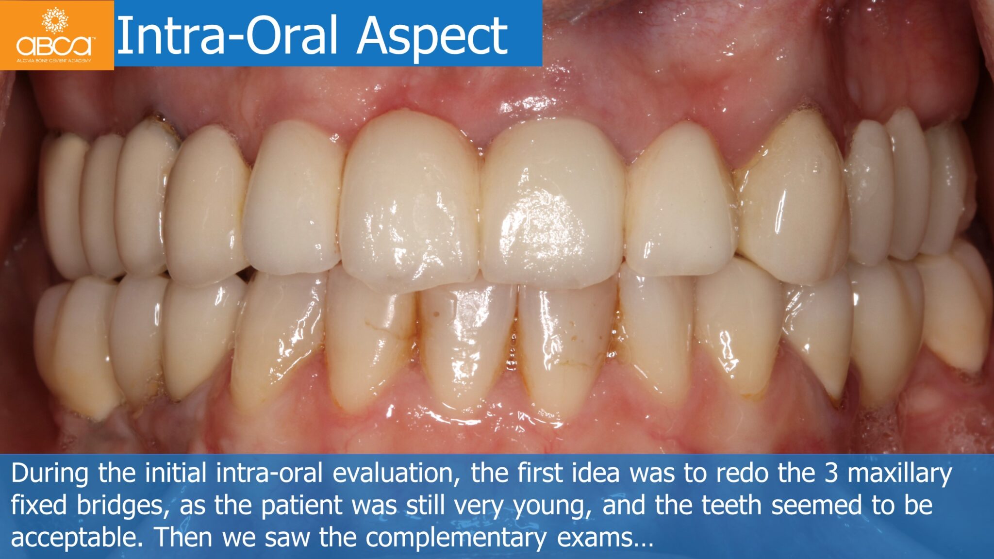Total Maxillary Rehabilitation in Two Phases with Bone Reconstruction ...