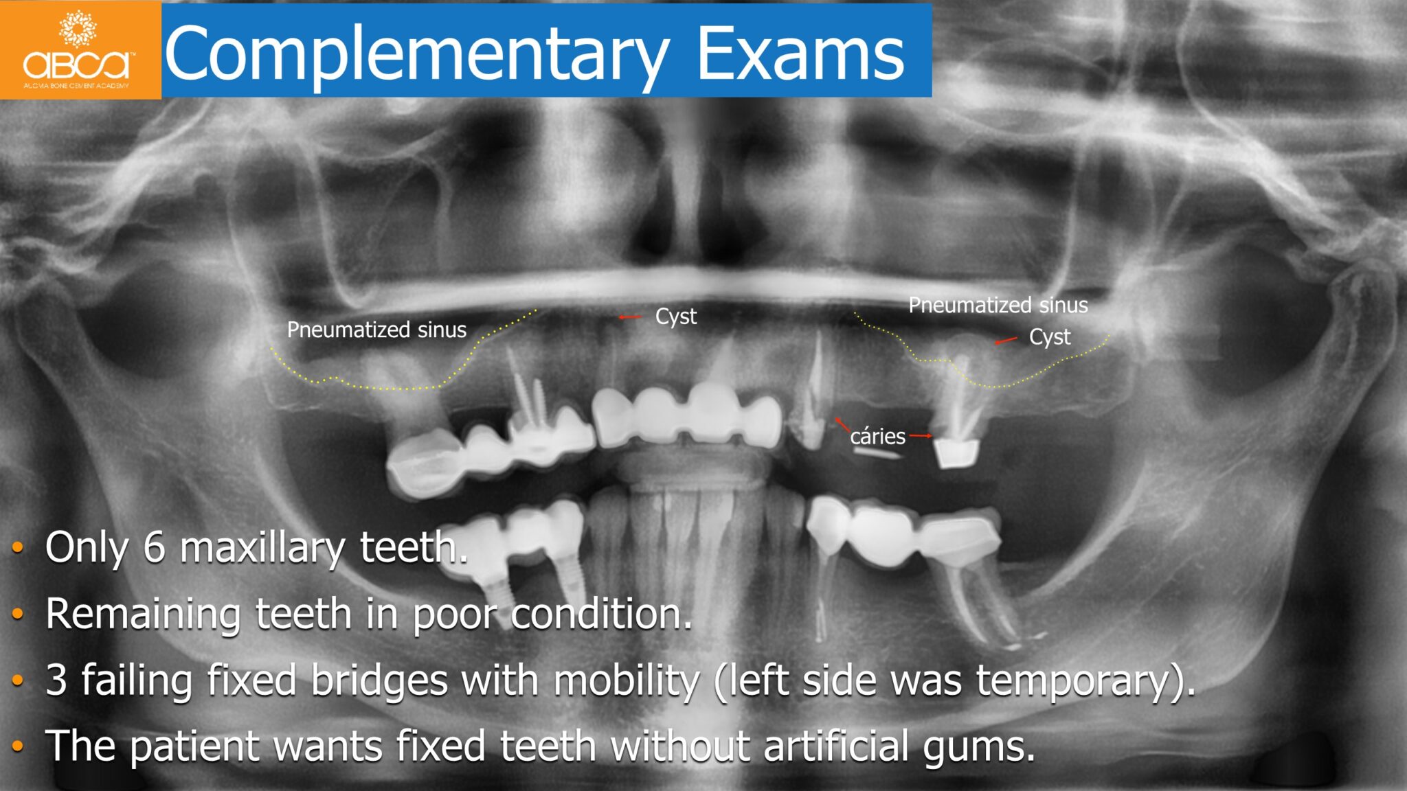 Total Maxillary Rehabilitation in Two Phases with Bone Reconstruction ...