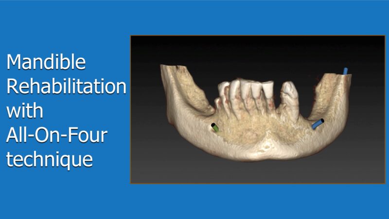 Mandible Rehabilitation with All-On-Four Technique - Augma Biomaterials