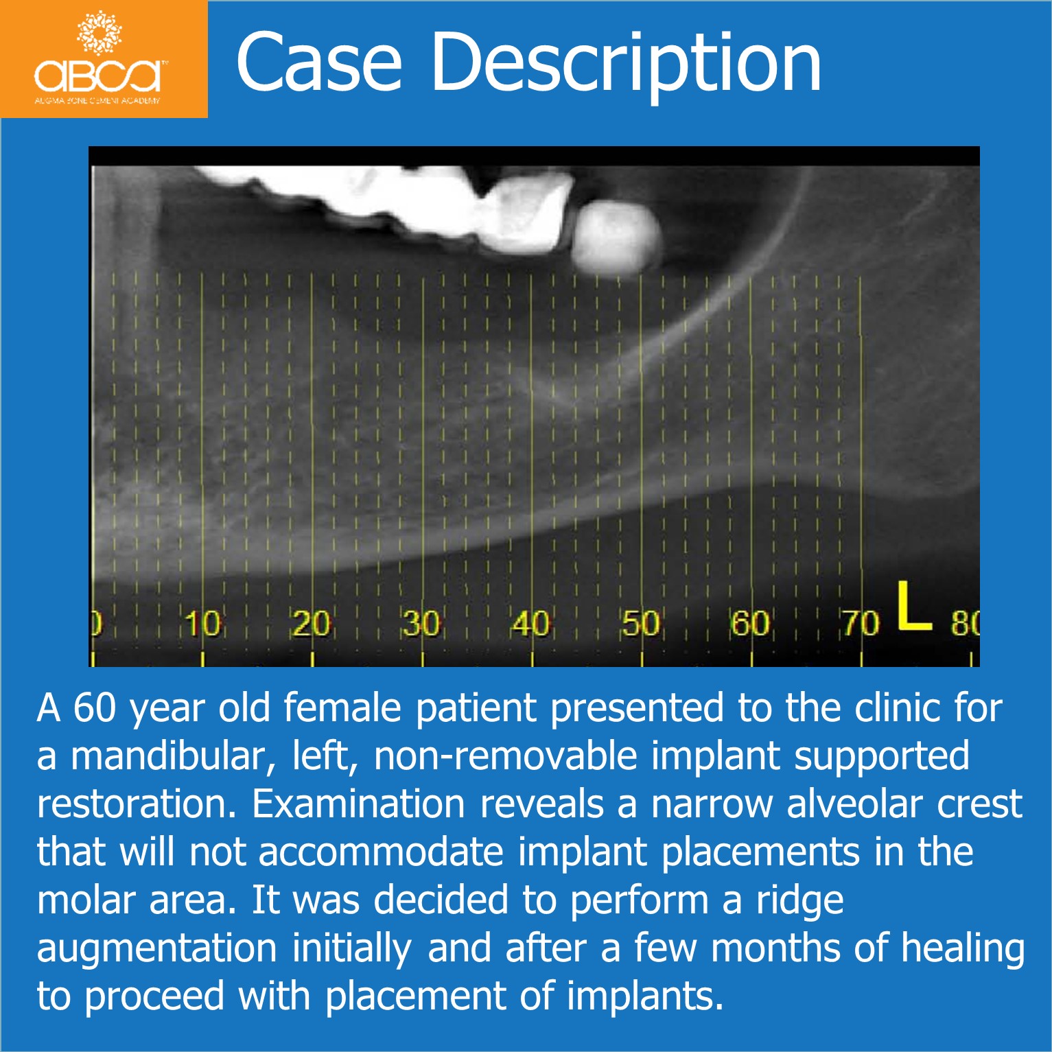 Lateral Ridge Augmentation with Augma Bond Apatite® - Augma Biomaterials