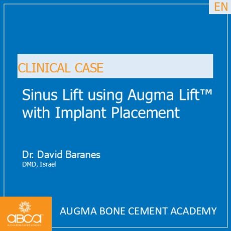 Sinus Lift using Augma Lift™ with Implant Placement - Augma Biomaterials