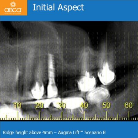 Sinus Lift using Augma Lift™ with Implant Placement - Augma Biomaterials