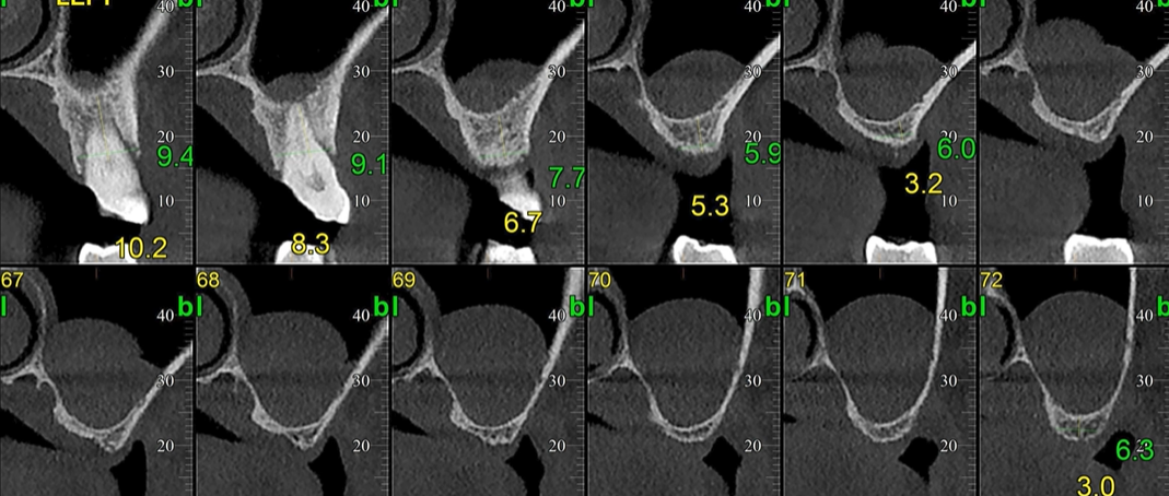 Augma Lift™ Surgery with Kit B - Augma Biomaterials