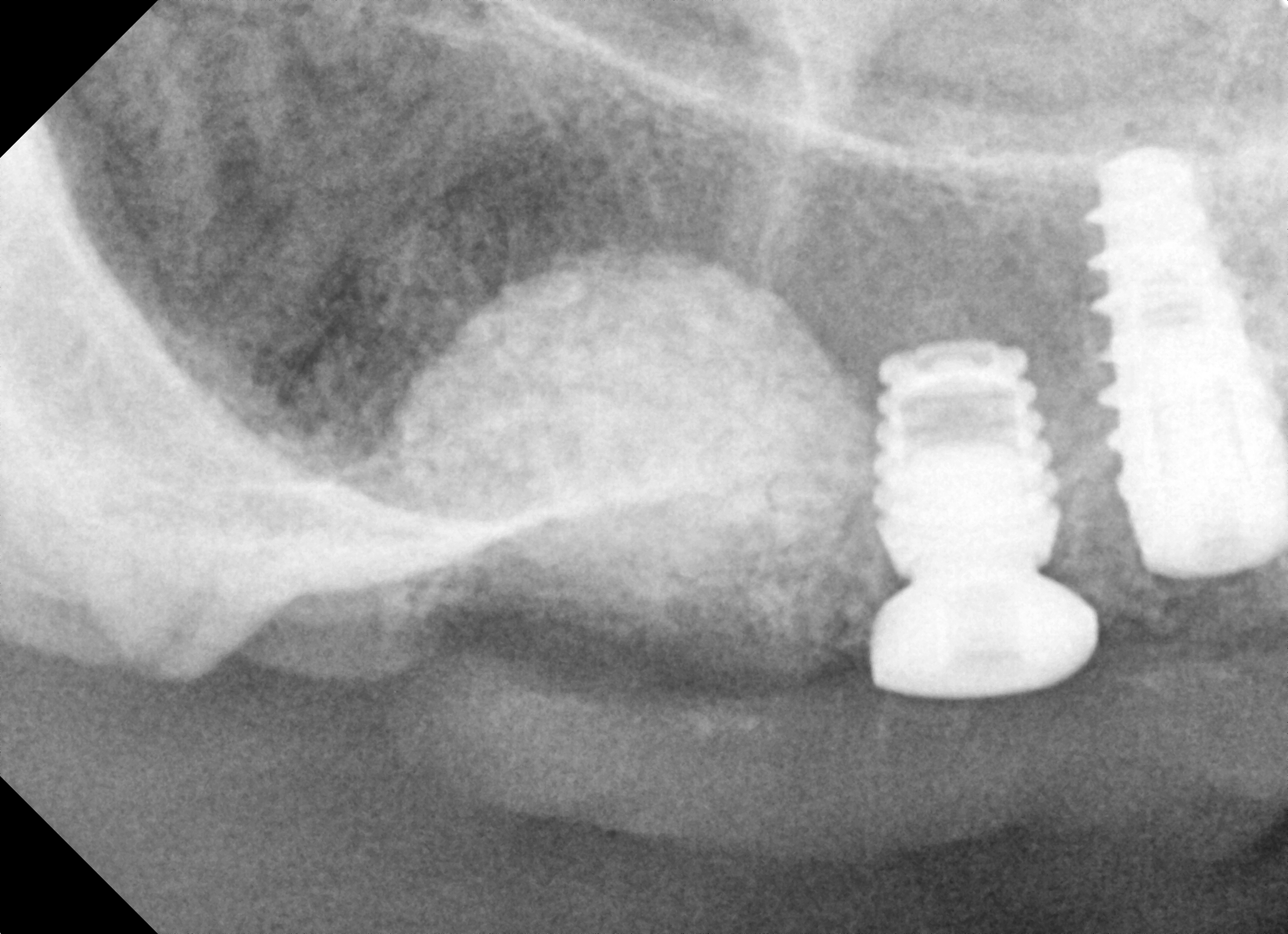 Augma Lift™ and Implants in 3 Steps - Augma Biomaterials