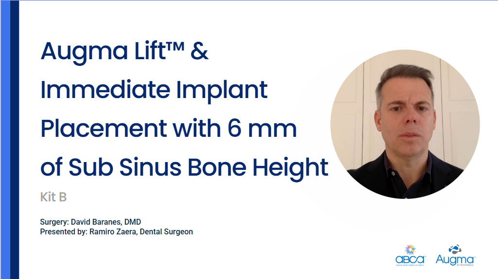 Augma Lift™ & Immediate Implant Placement with 6 mm of Sub Sinus Bone ...